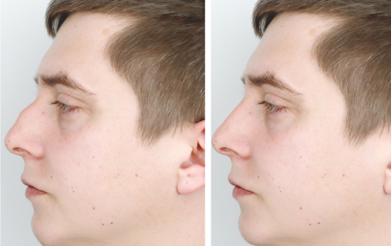 Dime que nariz tienes y te diré qué tipo de rinoplastia necesitas - Dr ...