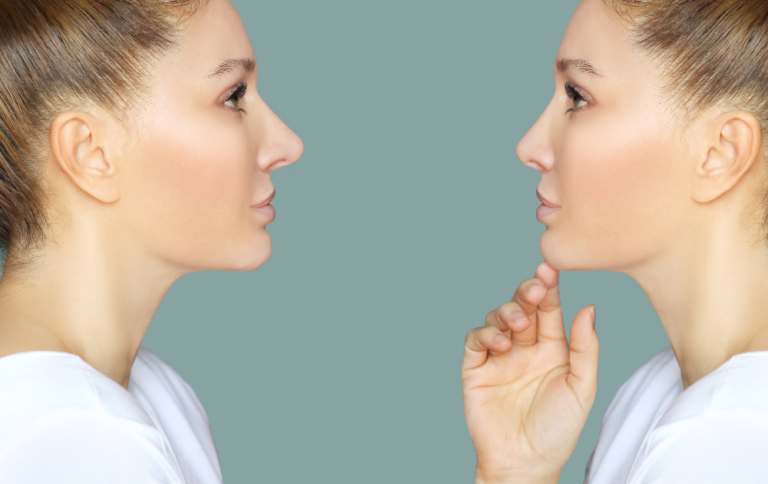 Dime que nariz tienes y te diré qué tipo de rinoplastia necesitas - Dr ...